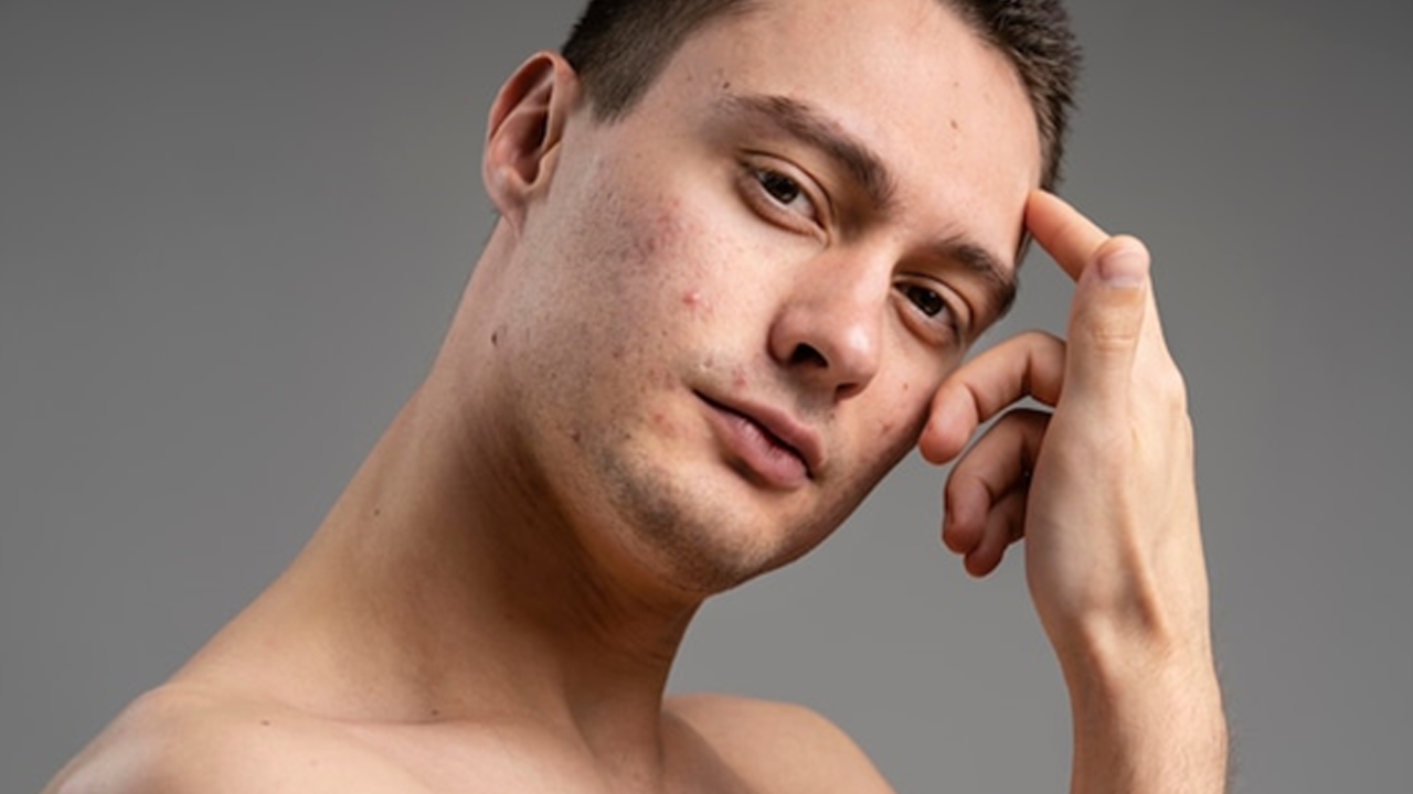 Mastering Acne: A Comprehensive Guide for Men